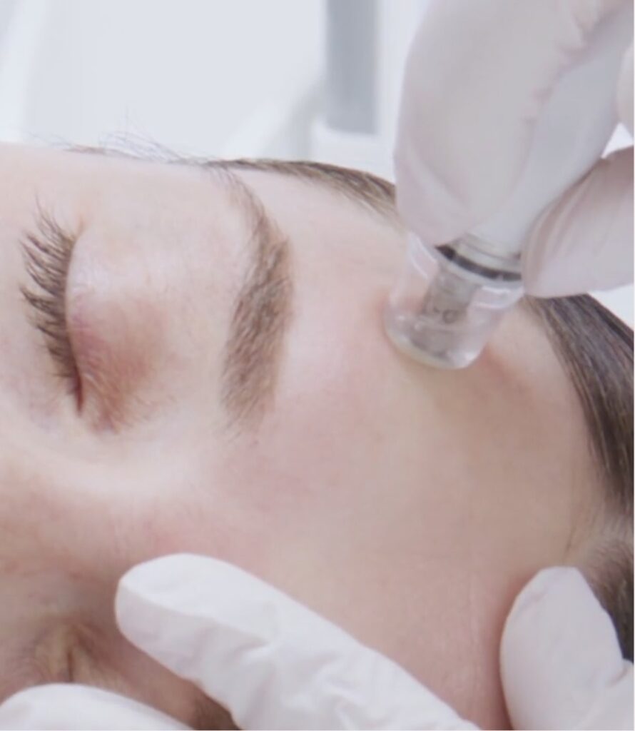 DiamondGlow™ Facial | Boston - Skin MD